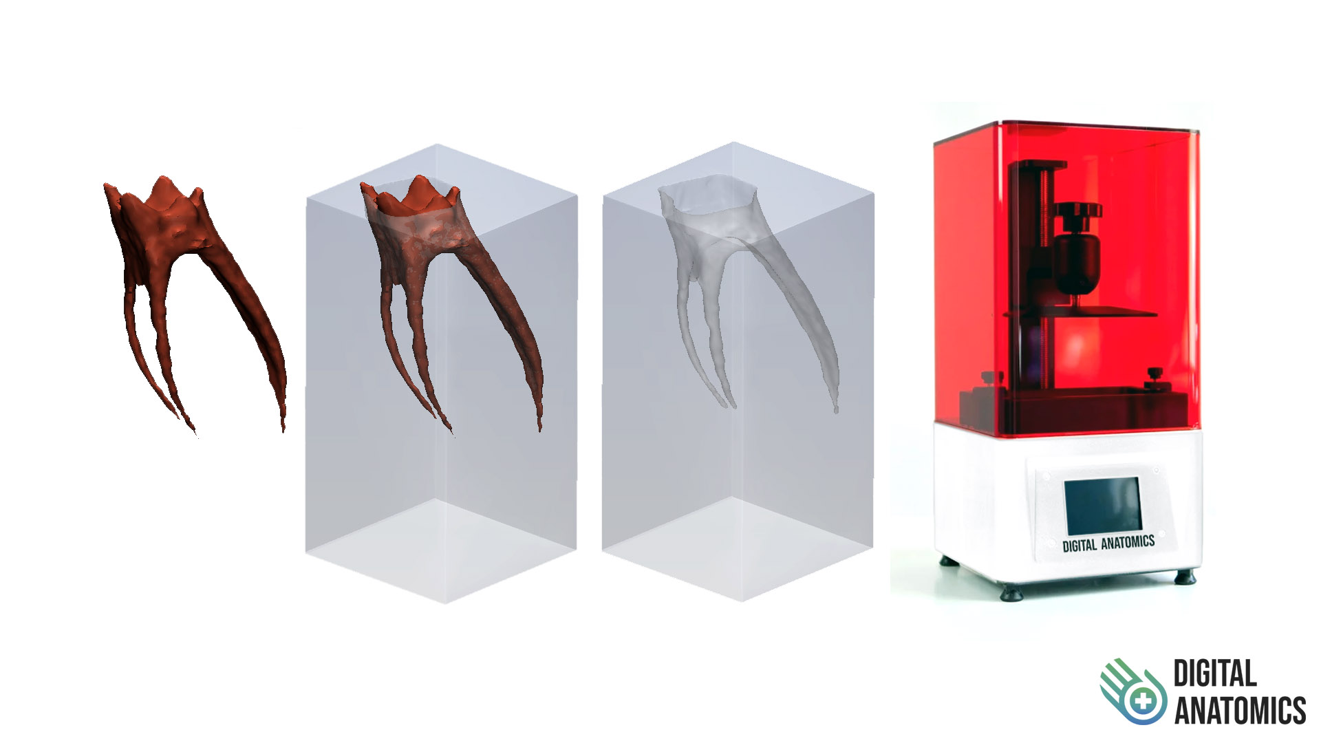 Three-dimensional endodontic planning with Endoplanning - Digital ...