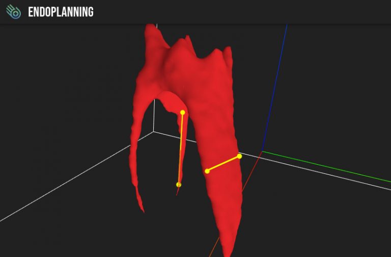 Three-dimensional endodontic planning with Endoplanning - Digital ...