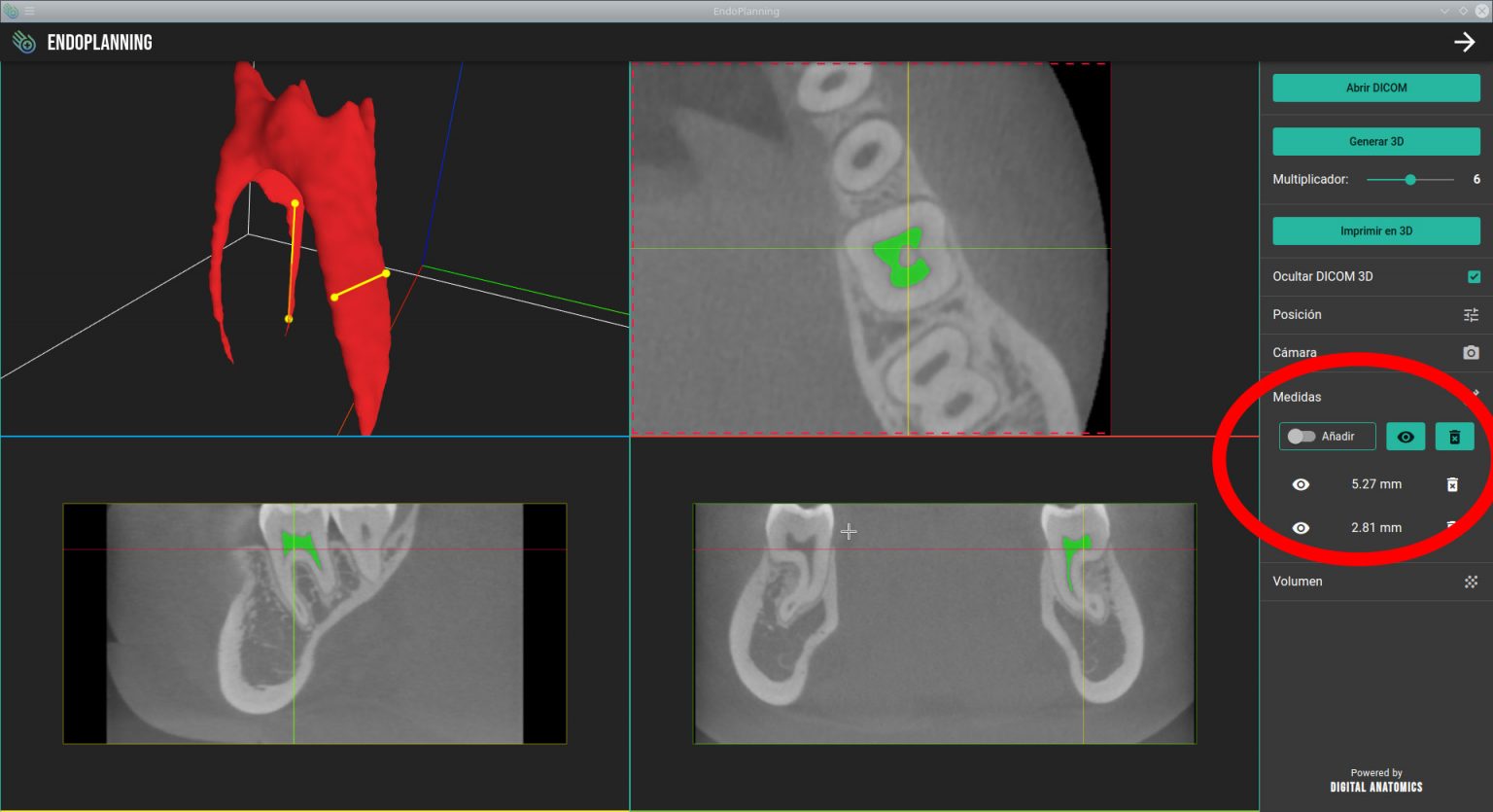 Three-dimensional endodontic planning with Endoplanning - Digital ...