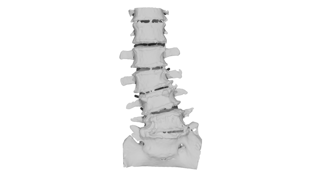 Use of surgical guides in Bertolotti syndrome. Spinal arthrodesis ...