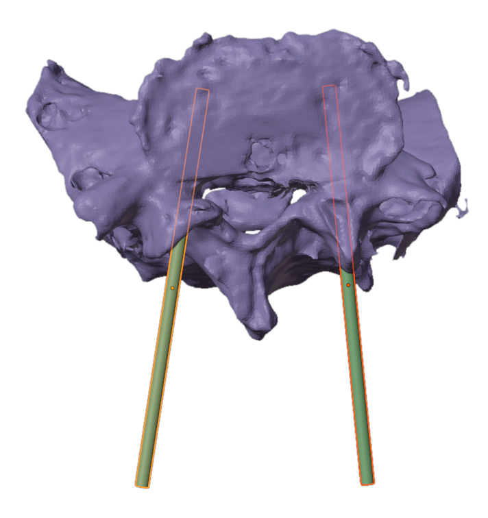 Use of surgical guides in Bertolotti syndrome. Spinal arthrodesis ...
