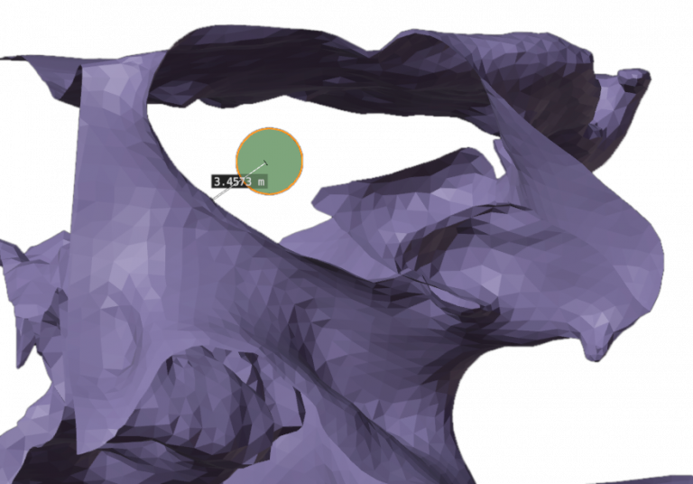 Use of surgical guides in Bertolotti syndrome. Spinal arthrodesis ...