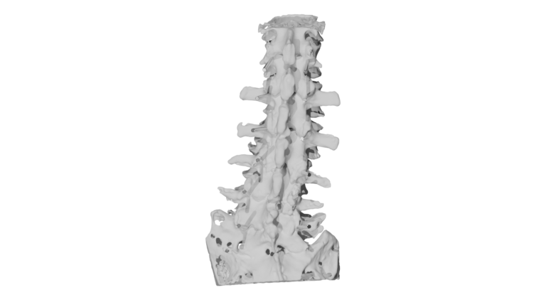 Use of surgical guides in Bertolotti syndrome. Spinal arthrodesis ...