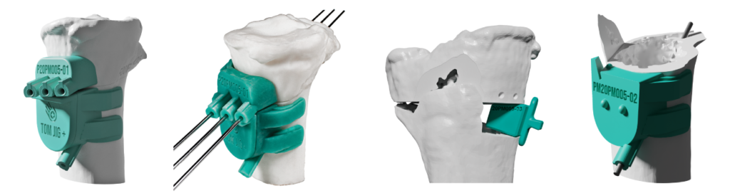TOM JIG - Tibial osteotomy - Digital Anatomics