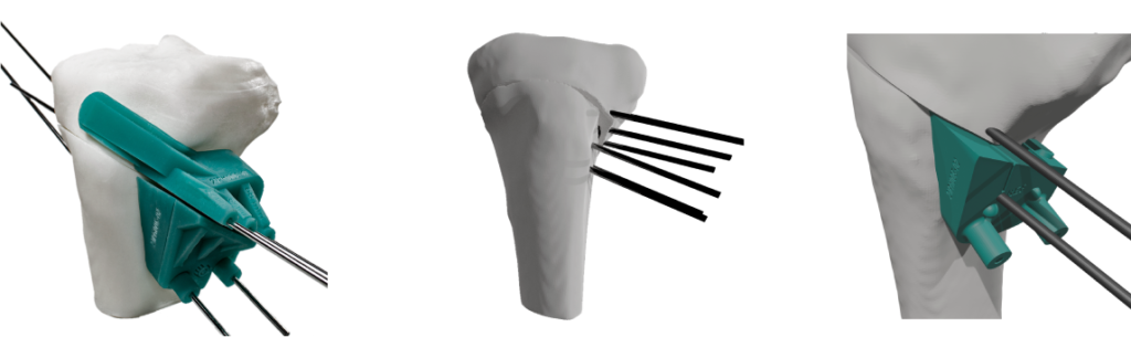 TOM JIG - Tibial osteotomy - Digital Anatomics