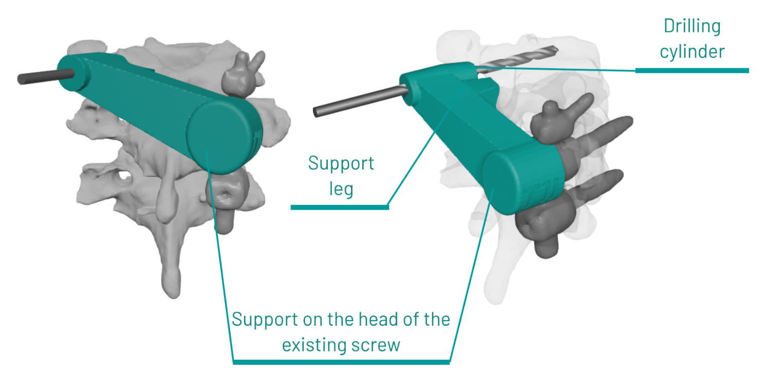 INNOVATION IN SPINE SURGERY: DIGITAL ANATOMICS' TOR JIG S R REVISION ...