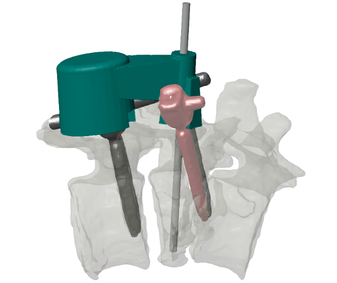 INNOVATION IN SPINE SURGERY: DIGITAL ANATOMICS' TOR JIG S R REVISION ...