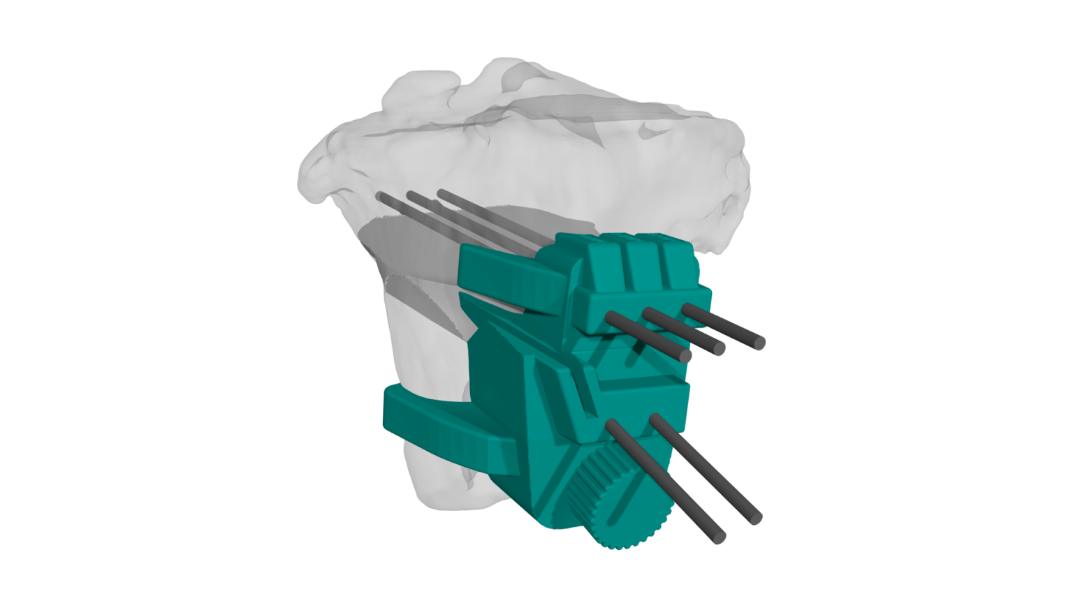 TOM JIG - Tibial osteotomy - Digital Anatomics