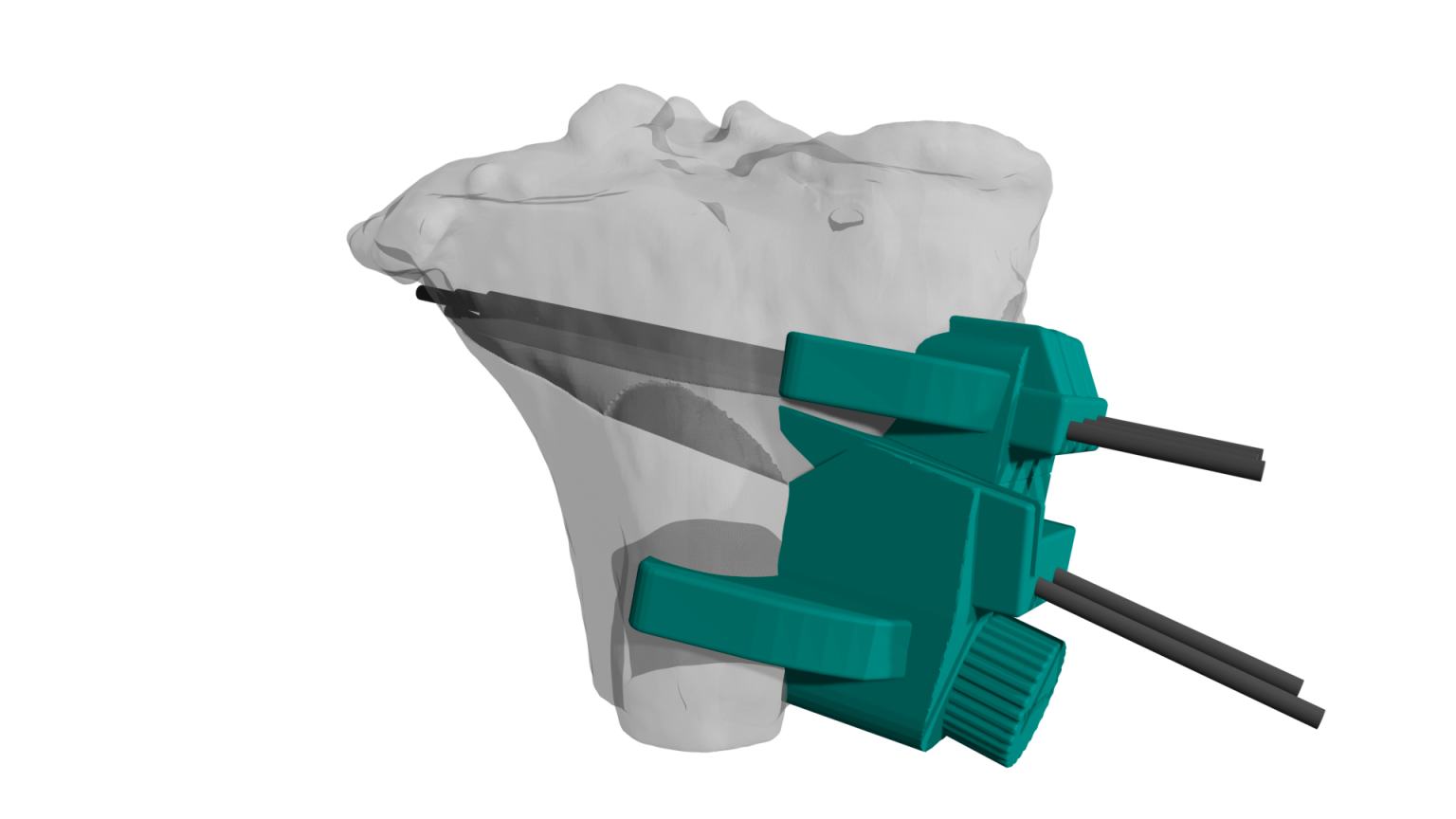 TOM JIG - Tibial osteotomy - Digital Anatomics