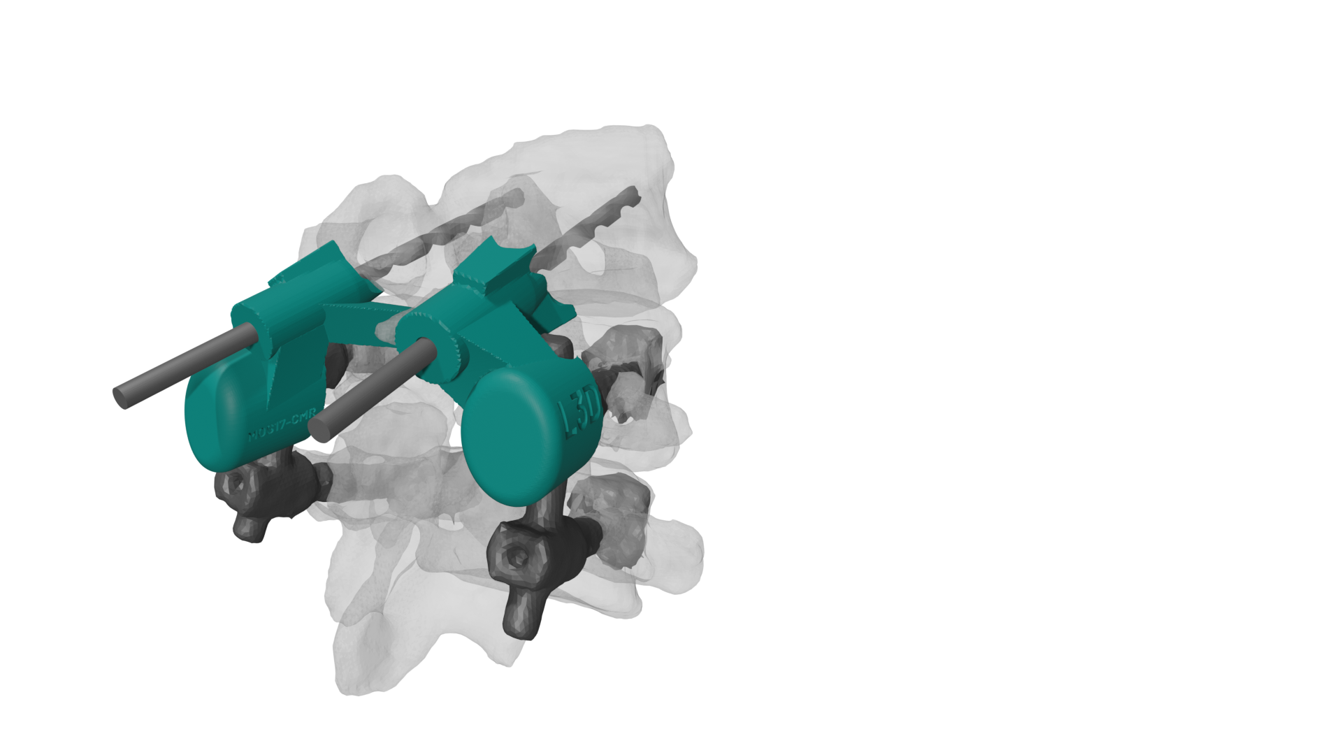 TOR JIG - Spinal fusion - Digital Anatomics
